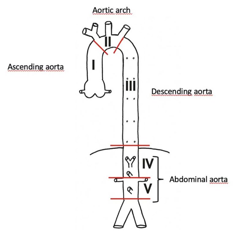 Aortic Surgery - The Baird Institute