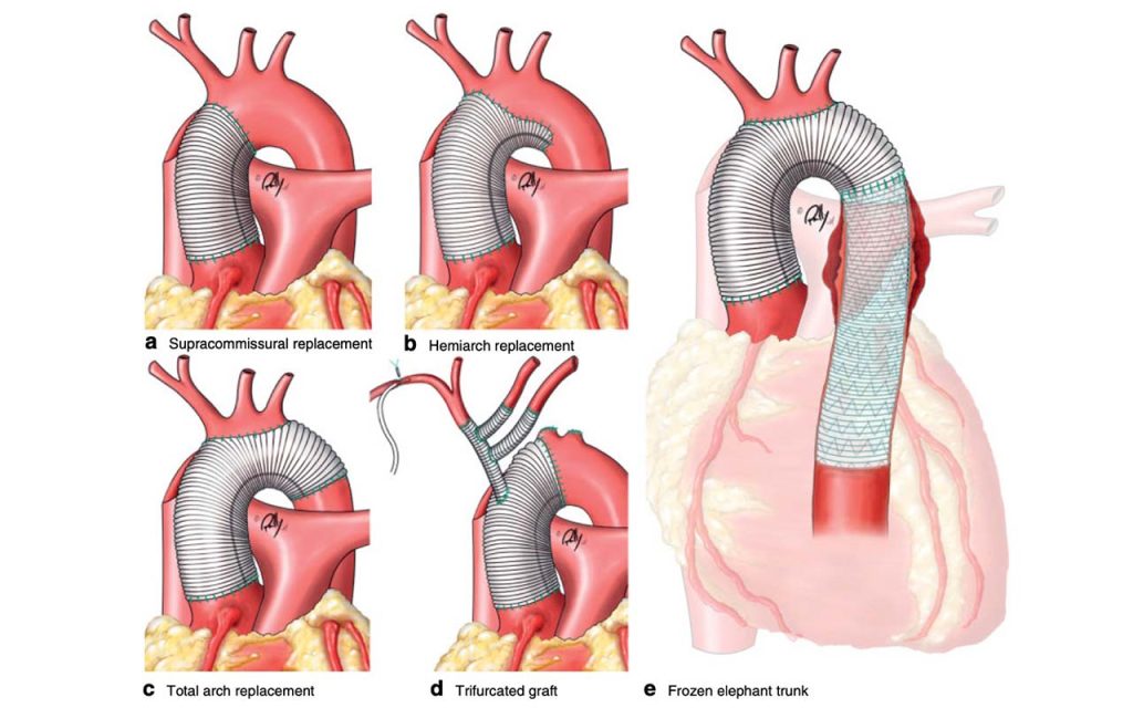 Aortic Surgery - The Baird Institute